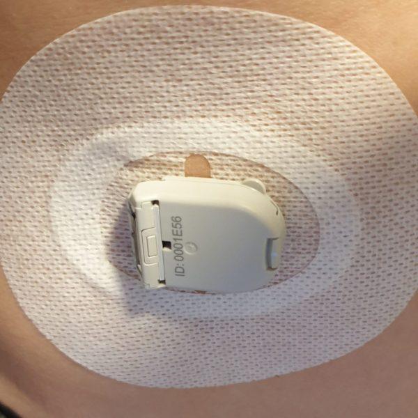 Glukosesensor - Schwerpunktpraxis Diabetes und Ernährungsmedizin